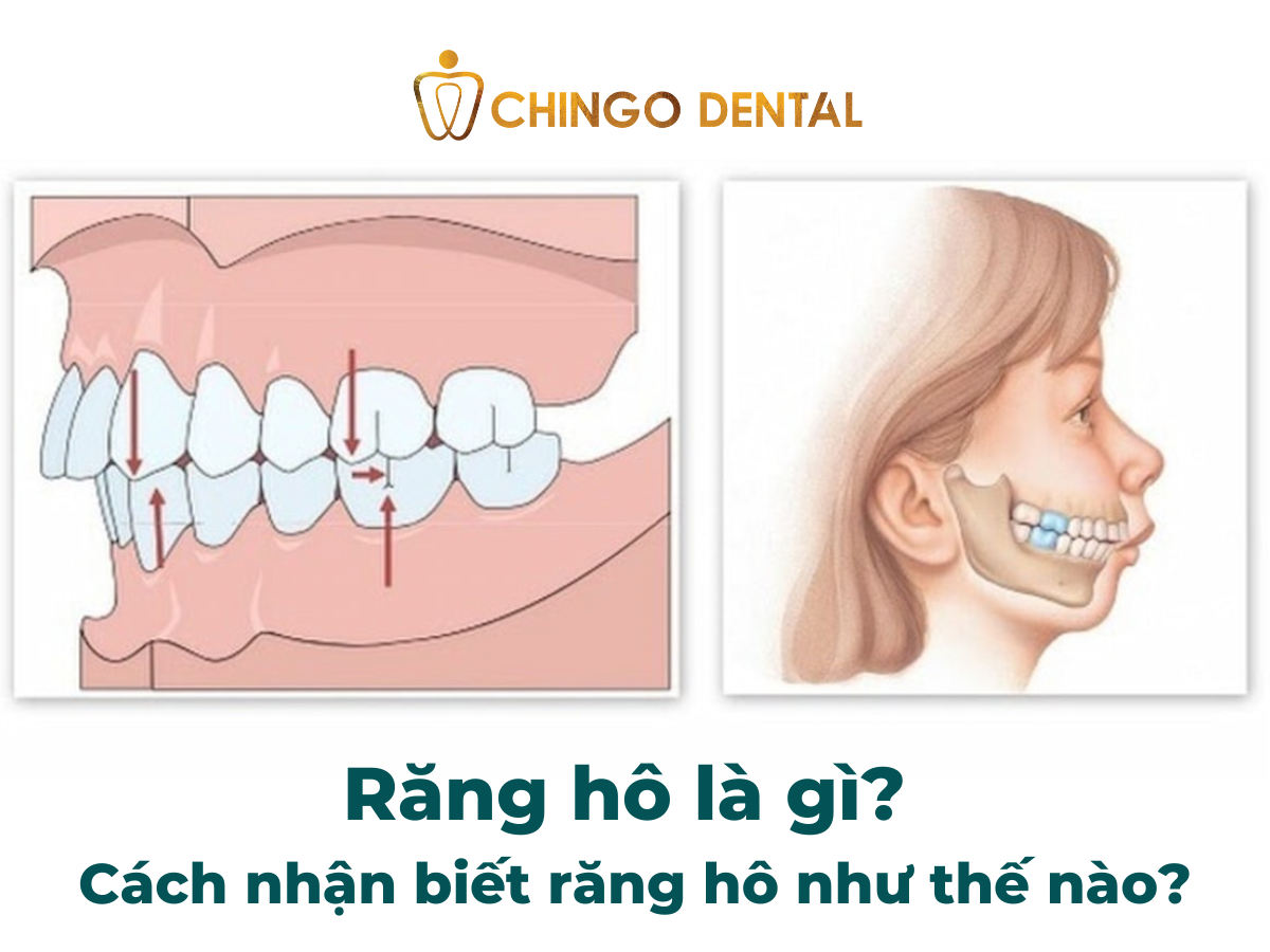 Răng hô là gì? Cách nhận biết răng hô như thế nào? - Nha Khoa Quốc Tế ...