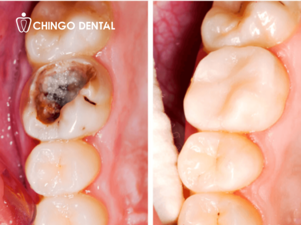 Trám răng inlay onlay là gì? Ưu điểm và quy trình trám răng inlay onlay ...